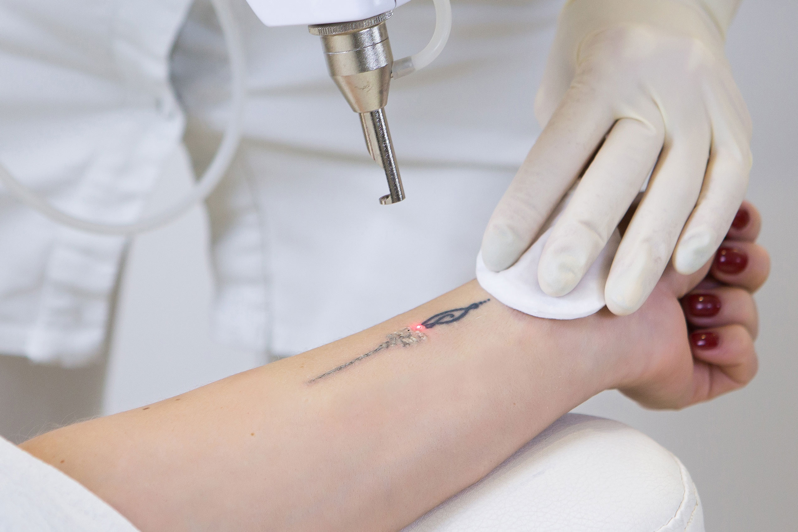 Laser - Dermatologie in Schenefeld